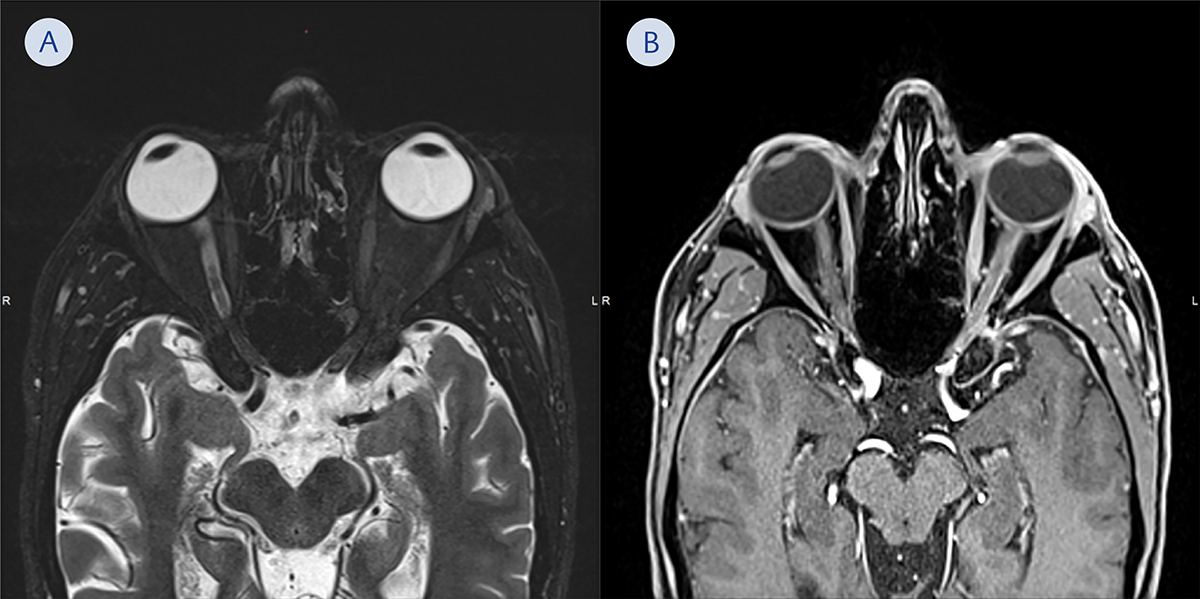 Orbital Apex Syndrome